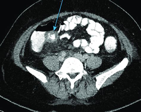 Tomodensitométrie de l abdomen coupe axiale Flèche iléite terminale