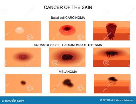 Images Of Different Types Of Skin Cancer
