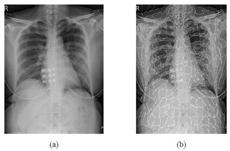 bioengineering free full text lung field segmentation in chest x ray images using superpixel