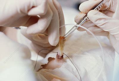 Umbilical Venous Catheter Stock Image M820 0603 Science Photo Library