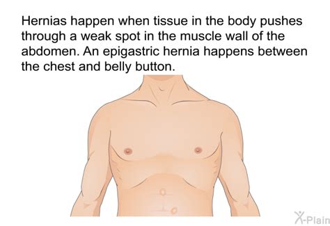 PatEdu Epigastric Hernia Repair Laparoscopic