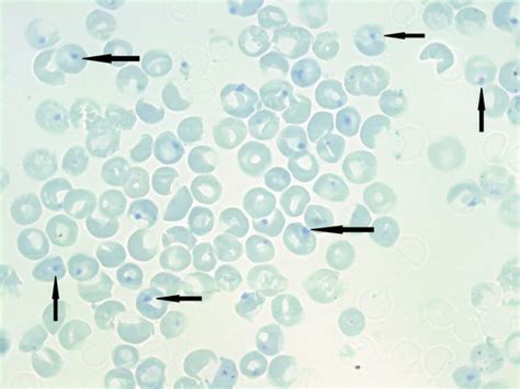 NN Hematology Types Of Anemias Flashcards Quizlet