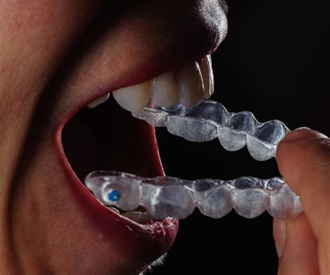 Ortodoncia Invisible Planificación Clínica Dental Blay Monzo