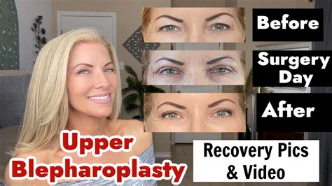 Upper Blepharoplasty Eyelid Surgery Recovery Pics And Videos