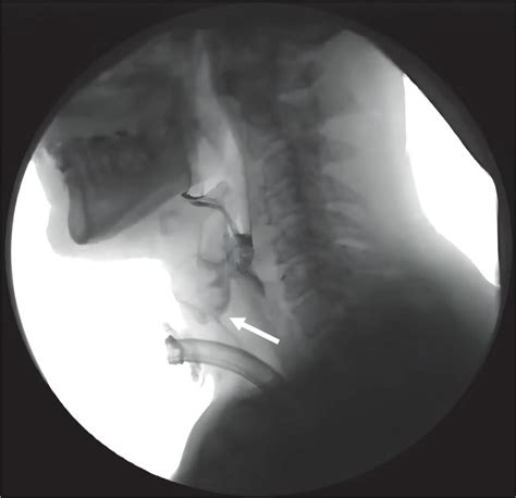 Biomechanical Mechanism Of Reduced Aspiration By The Passy Muir Valve