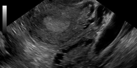 How Are Uterine Polyps Diagnosed And Treated Euromed