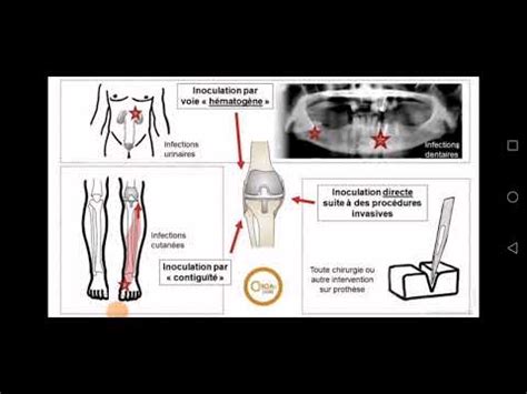 les infections ostéo articulaires YouTube