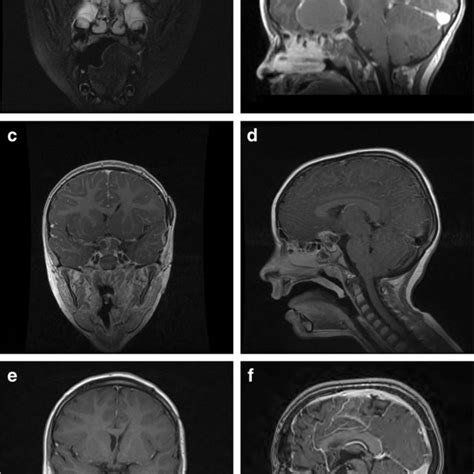 A And B T2 Weighted Coronal And Post Contrast T1 Weighted Sagittal MRI