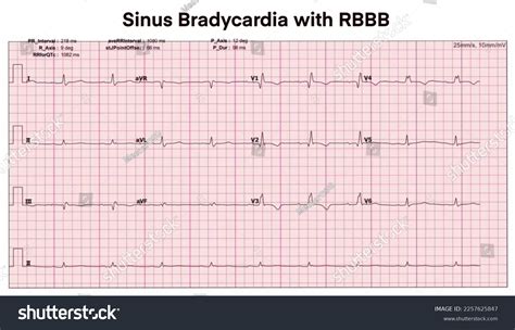Electrocardiogram Show Sinus Bradycardia Rbbb Heart Stock Illustration