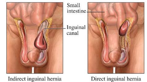 Indirect Inguinal Hernia And Direct Inguinal Hernia Medizzy