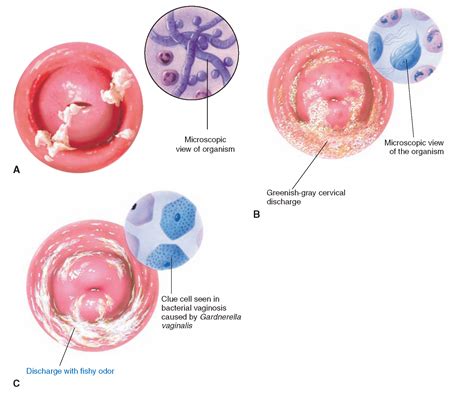 Sexuality Fertility And Sexually Transmitted Infections Maternal And Newborn Nursing Part 5