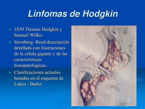 PPT Clasificación Histopatológica de los Linfomas de Hodgkin