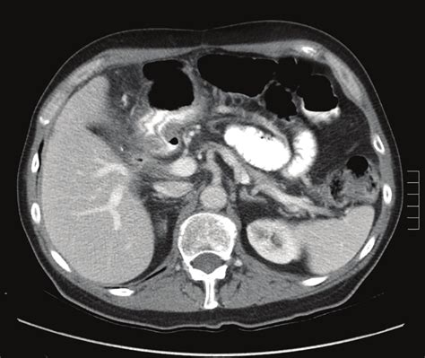 Abdominal Ct Scan Pancreatic Cancer
