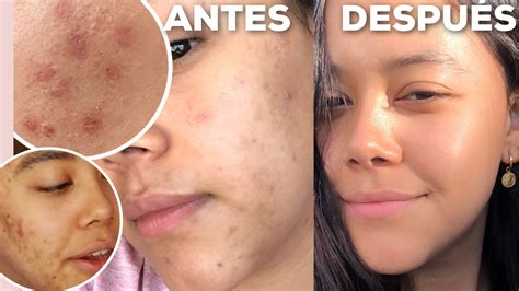 Cómo eliminar manchas rojas de la piel lilimpieza