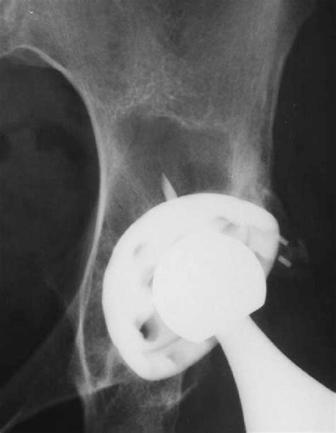 Wear Osteolysis Basic Science Recon Orthobullets