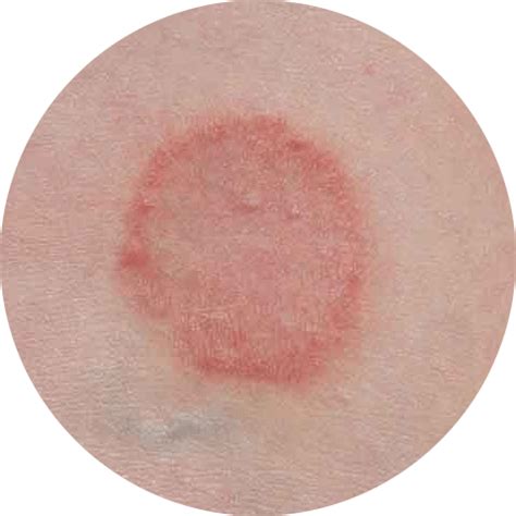 Ringworm Rashes Causes And Treatments Remotederm
