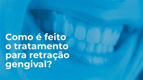 Como é feito o tratamento para retração gengival Ápex Odontologia