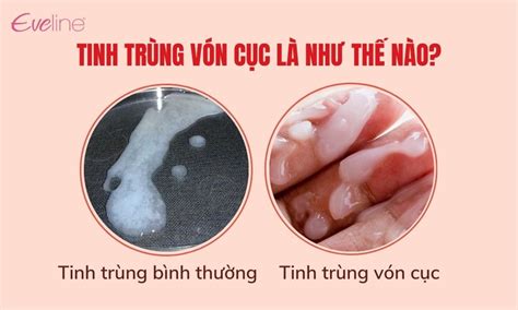 Nam giới bị tinh trùng vón cục có con được không
