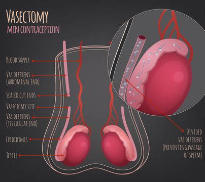 Vasectomy What Is The Procedure Of Vasectomy