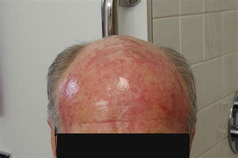 Penting 5 Fluorouracil Treatment Terbaru