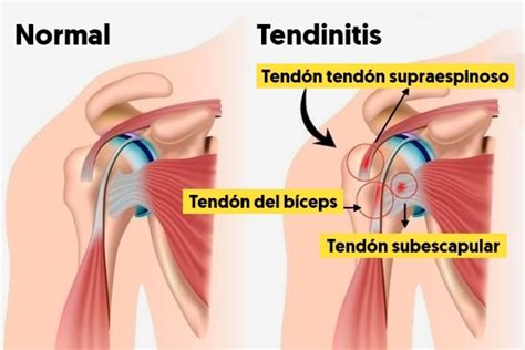 Tendinitis en el hombro Causas síntomas y tratamientos Blog Clínica
