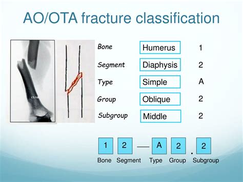 Ppt Principles Of Fractures Fracture Management Powerpoint