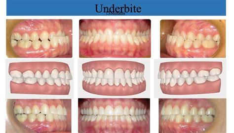 Overbite Braces Change Face Shape Before And After