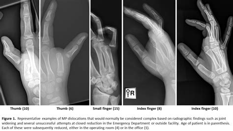 Metacarpophalangeal Joint Dislocation
