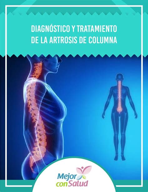 Diagn Stico Y Tratamiento De La Artrosis De Columna Columnas