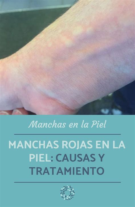Manchas Rojas En La Piel Que Aparecen Y Desaparecen Causas Y