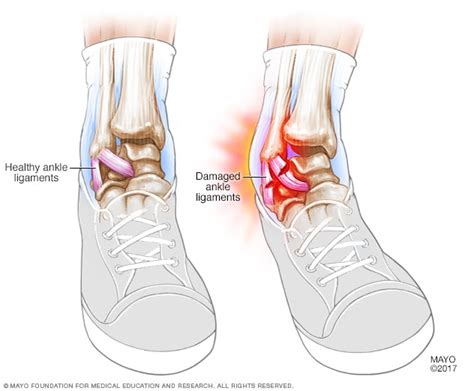 Sprained Ankle Symptoms And Causes Mayo Clinic