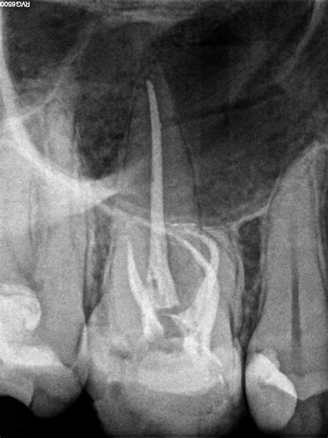 Leczenie kanałowe pod mikroskopem Endodoncja Kraków
