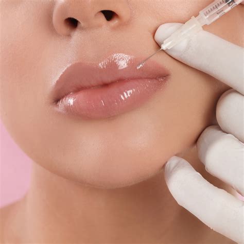 Los increíbles resultados del relleno de labios con ácido hialurónico