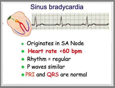 ECG Normal Sinus Rhythm Video Anatomy Definition Osmosis 45 OFF