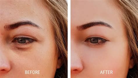 PRP For Under Eyes Oakdale Woodbury MN
