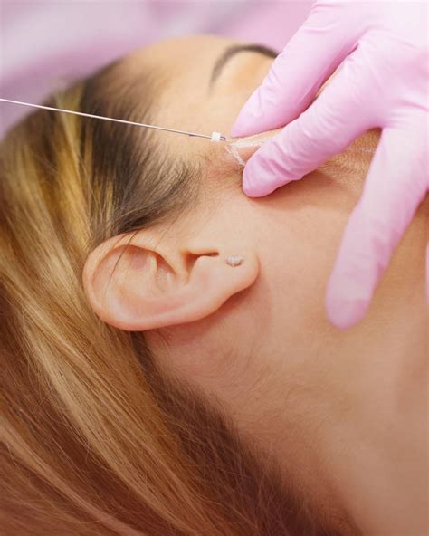 Fios de sustentação e ou estímulo de colágeno Instituto Dermatológico
