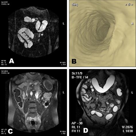 CT And MR Colonography Scanning Techniques Postprocessing And