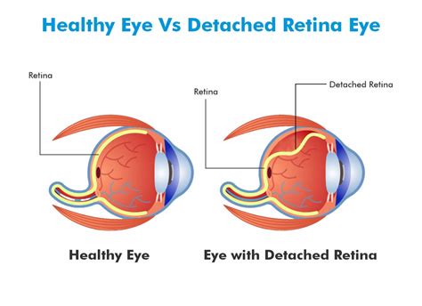 Warning Signs Symptoms Treatment Retinal Detachment
