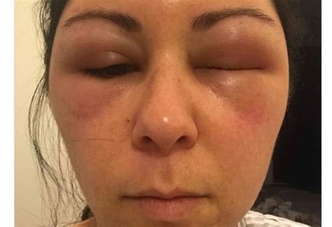 Se tiñó el pelo y tuvo una reacción alérgica que le deformó el rostro