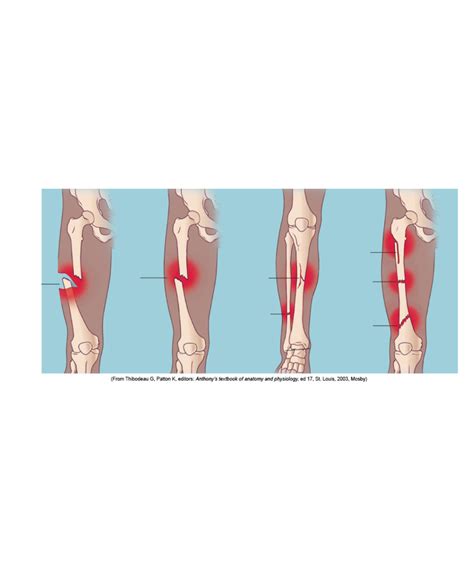 Fracture Types Diagram Quizlet