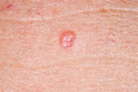 Basal Cell Carcinoma Skin Cancer Stock Image C037 0923 Science