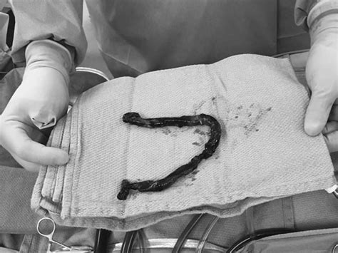 Surgical Pulmonary Embolectomy Circulation