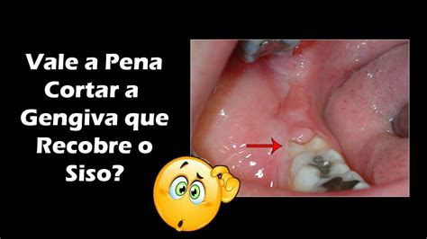Dente do Siso Vale Mais a Pena Cortar a Gengiva ou Fazer a Extração