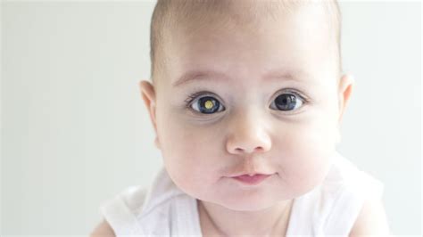 Retinoblastoma Entenda O Que E Os Sinais Desse Tipo De C Ncer
