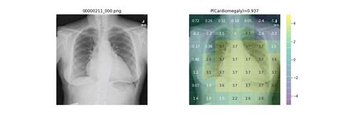 chest x ray computer aided diagnosis using deep learning devpost
