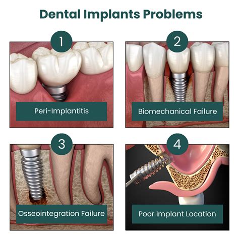Dental Implants Problems Riverside Oral Surgery