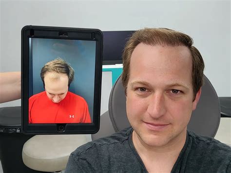 Before After Hair Restoration Aesthetics Of Buffalo