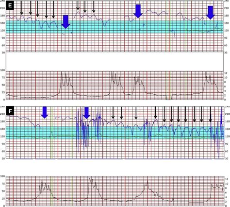 AJOG On Twitter AJOG Expert Review In Labor Abnormal Fetal Heart