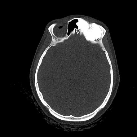 Paranasal Sinus Osteoma Radiology Reference Article Radiopaedia Org