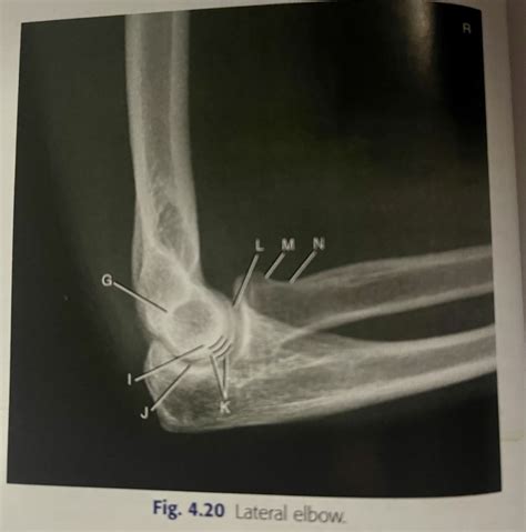 Lateral Elbow Labeling Diagram Quizlet
